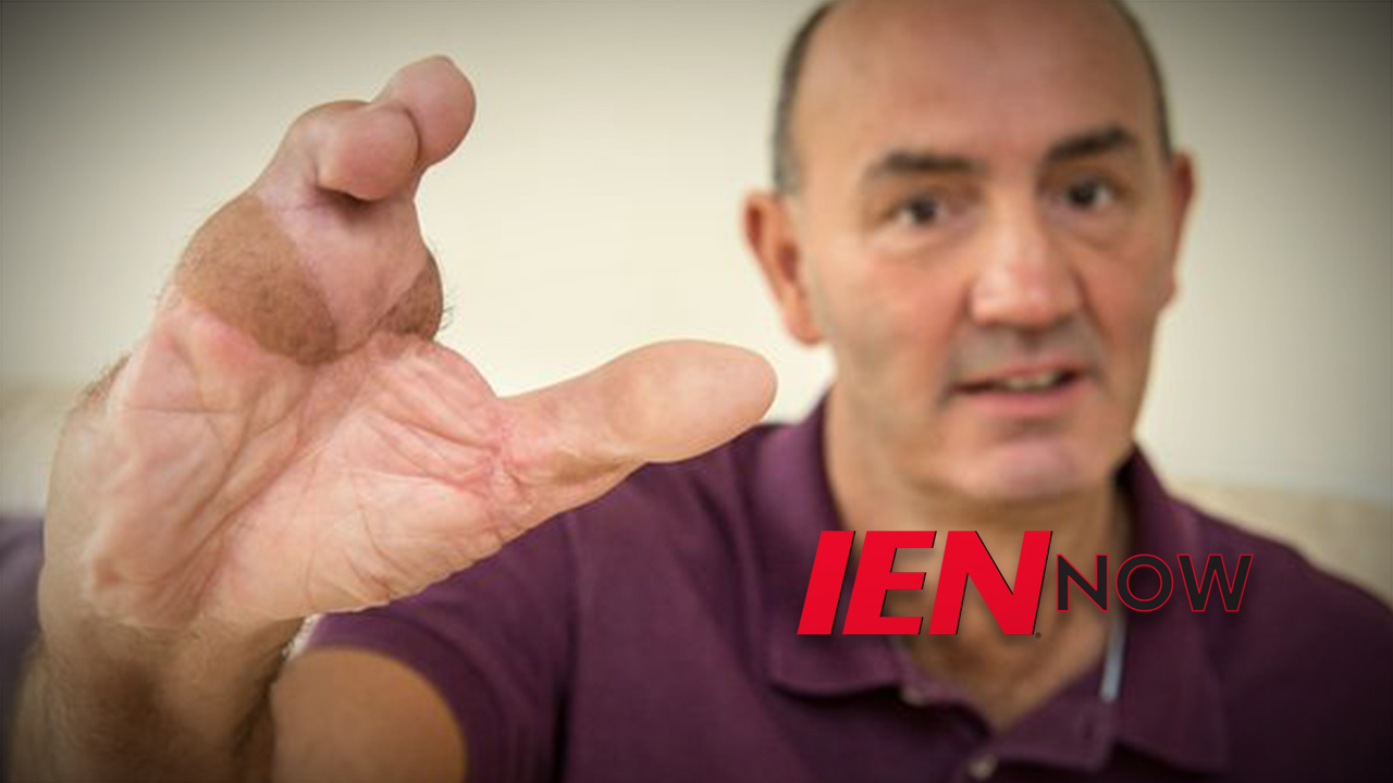 Man Has Toes for Fingers After Accident | Industrial Equipment News